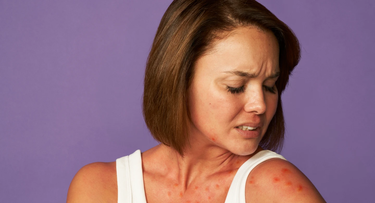 Nesselsucht (Urtikaria): Symptome und Behandlung | Allegra®